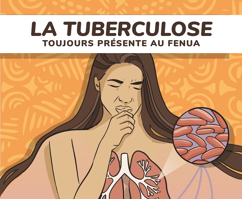 Tuberculose : 56 cas et 3 décès l’an dernier au fenua - Radio1 Tahiti